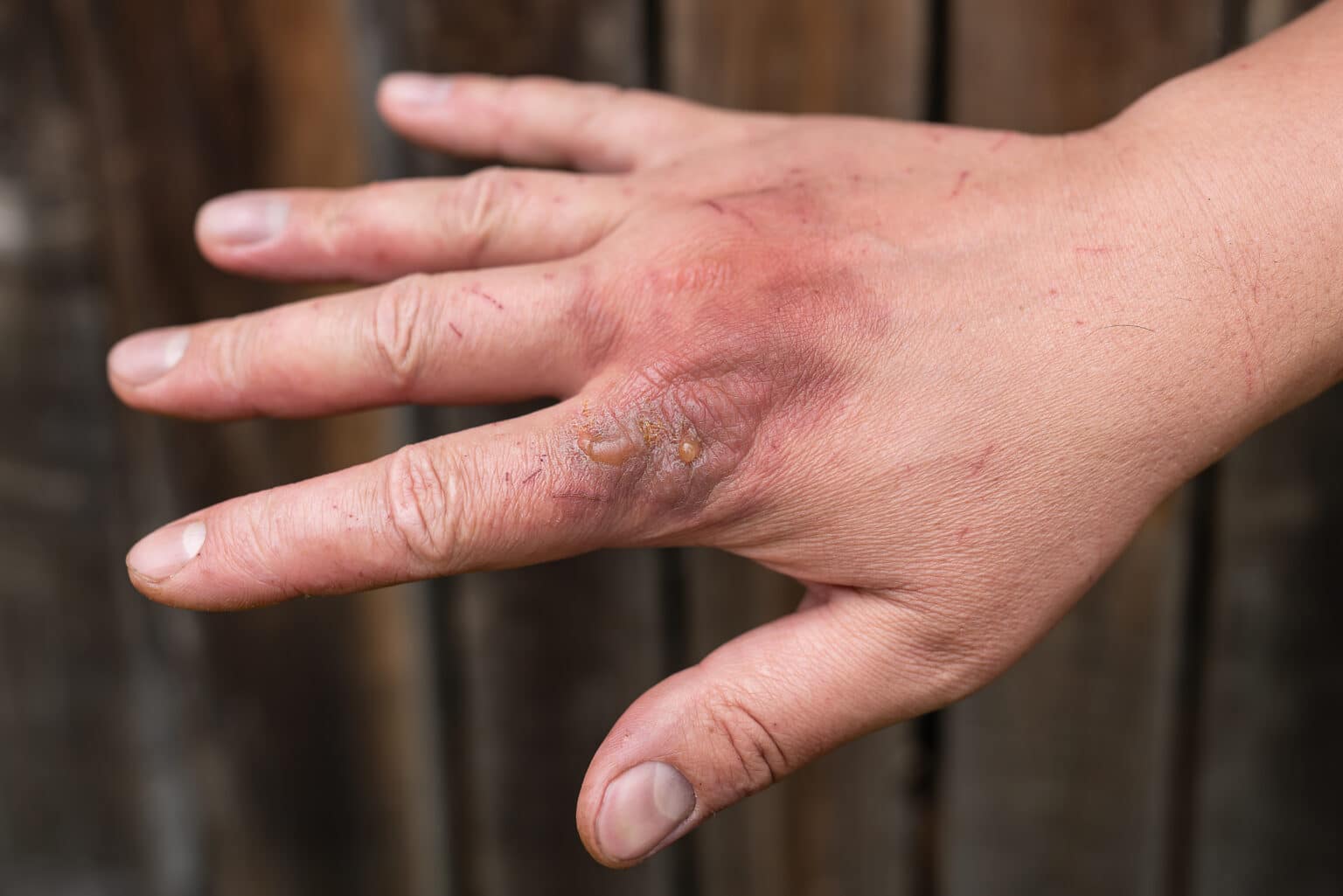 Identifying Insect Bites and Stings: A Guide to Bites | STC