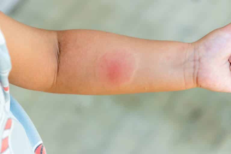 First Aid for Spider Bites: Symptoms & Treatment | STC