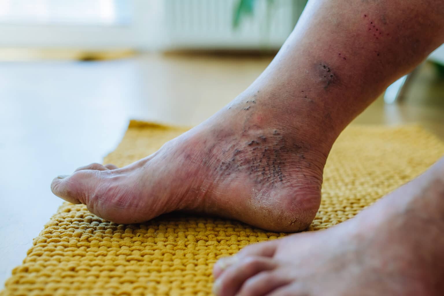 Gangrene: Symptoms, Causes, Diagnosis, and Treatment