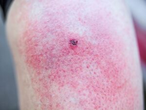 Redback Spider Bite First Aid: What You Need to Know | STC